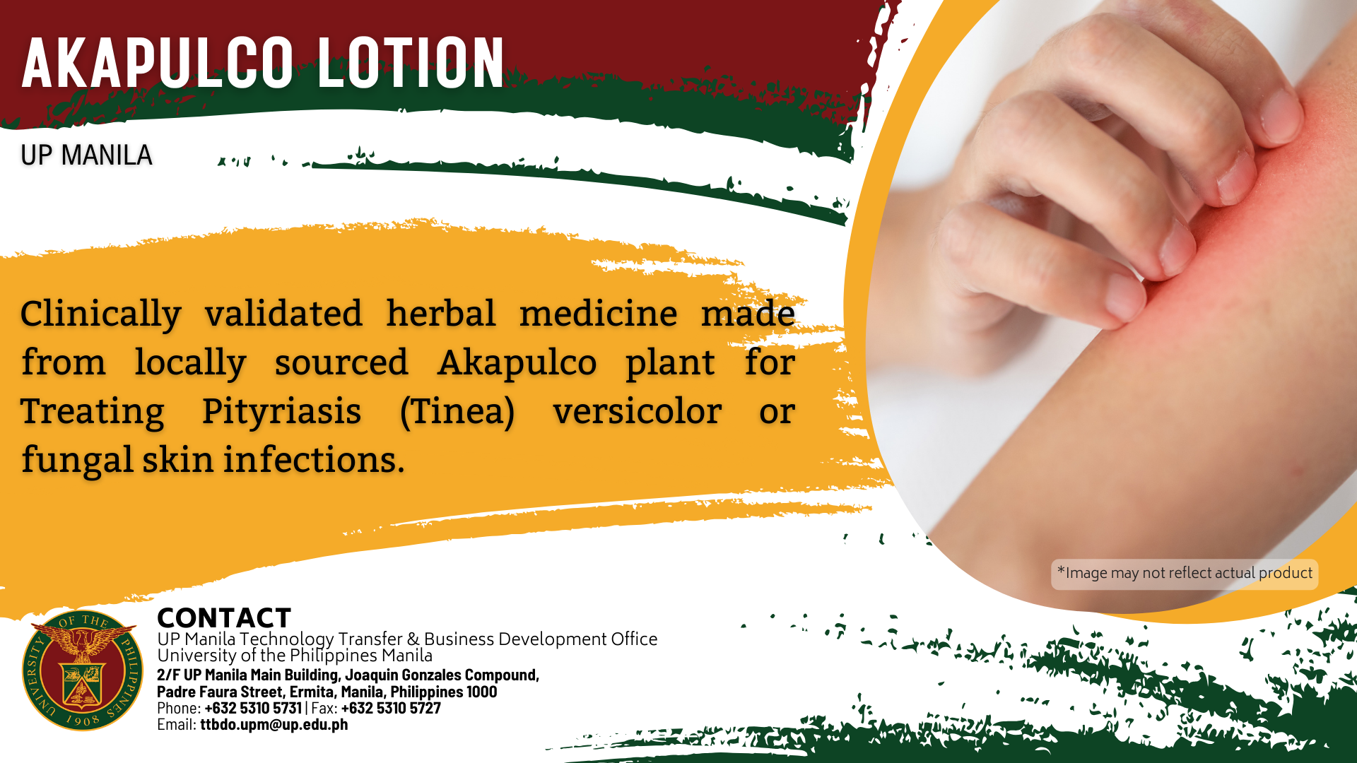 Akapulco lotion for fungal skin infection – UP Manila TTBDO